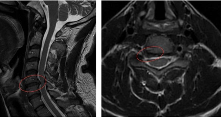 Cervicobraquialgia: Causas, Sintomas e Tratamentos - Dr. William Zarza