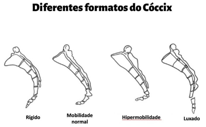 Coccidínia (dor no cóccix): Sintomas, Diagnóstico e Tratamento