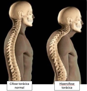 Cifose - Tipos de cifose, Sintomas e Tratamentos - Dr. William Zarza