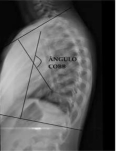 Cifose ou Corcunda: Tipos, Sintomas e Tratamentos