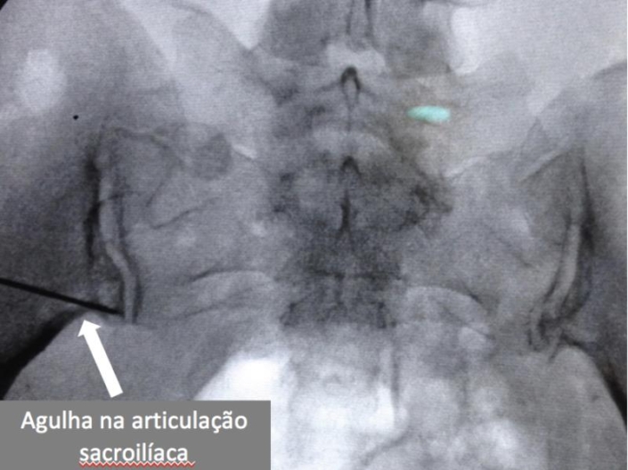 Sacroileíte: O que é, sintomas, causas e tratamentos - Dr. William Zarza