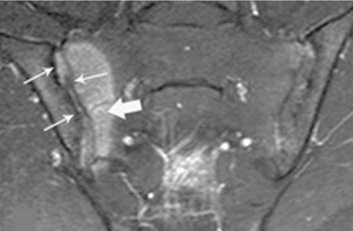 Sacroileíte: O que é, sintomas, causas e tratamentos - Dr. William Zarza